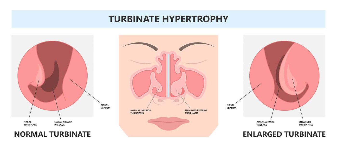 Large Inferior Turbinate Symptoms Causes Diagnosis And Treatment large-inferior-turbinate-symptoms-causes-diagnosis-and-treatment